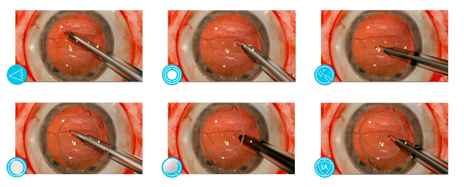 💉 CapsuleGuard® IA, the silicone irrigation/aspiration (IA) handpiece ...